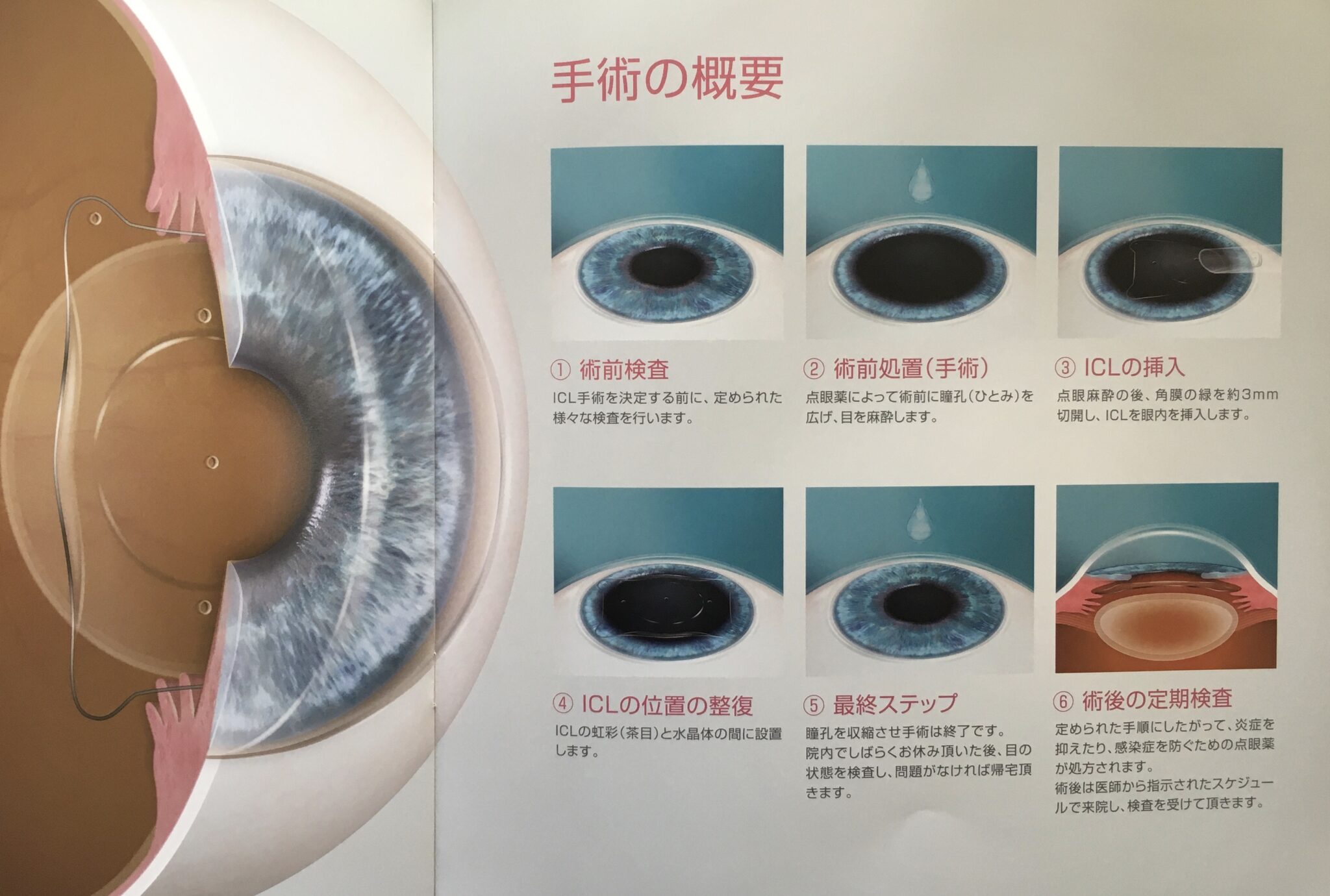 ICL手術って何？手術の流れ、費用、特徴、術後は？レーシックとどっちがいい？【実体験】 - 自由をつくる、ブログ。